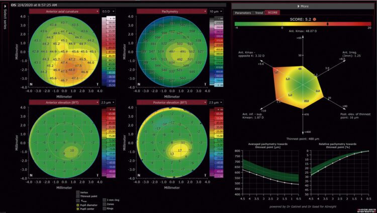 Conozca las nuevas funciones de ANTERION® – Oftalmólogo al Día