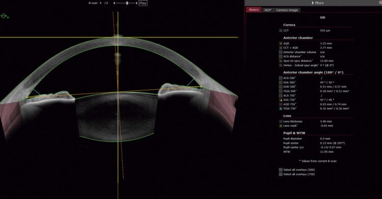 Conozca las nuevas funciones de ANTERION® – Oftalmólogo al Día