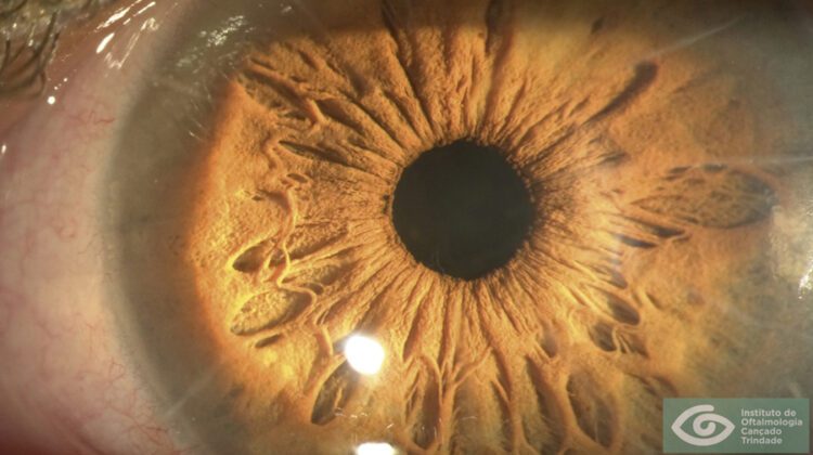 Tratamiento del astigmatismo corneal irregular – Oftalmólogo al Día