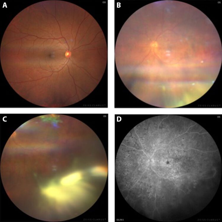 Endoftalmitis estéril posterior a implante de dexametasona intravítreo ...