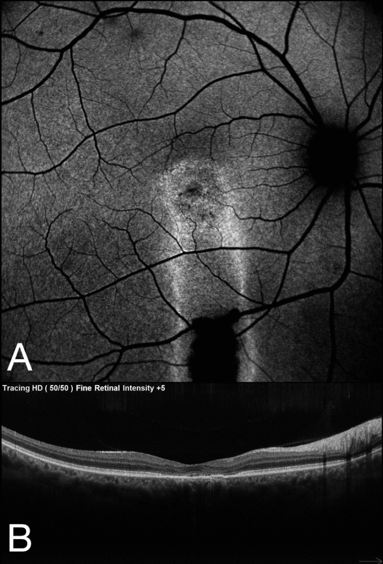 Imagen multimodal en coriorretinopatía serosa central – Oftalmólogo al Día