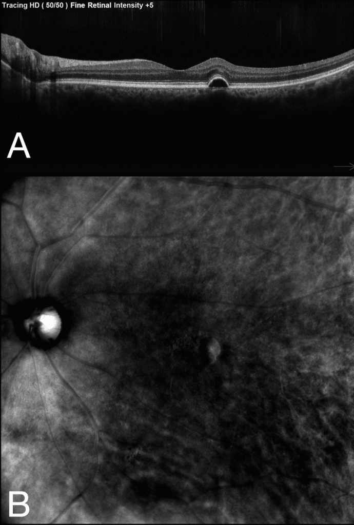 Imagen multimodal en coriorretinopatía serosa central – Oftalmólogo al Día