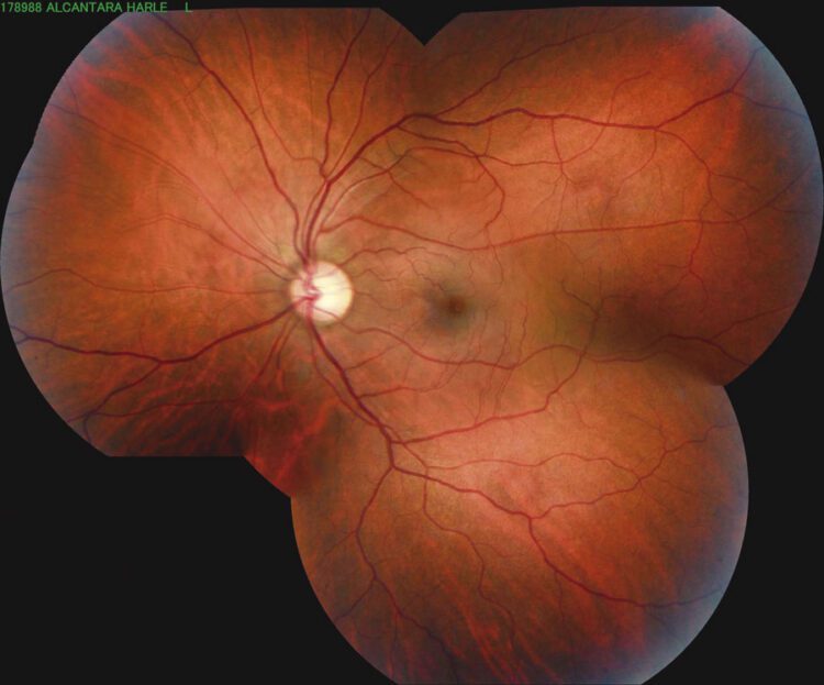 Oclusión mixta de la vena central de la retina y de rama de la arteria ...