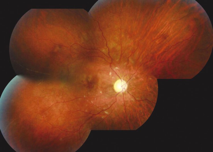 Oclusión mixta de la vena central de la retina y de rama de la arteria ...