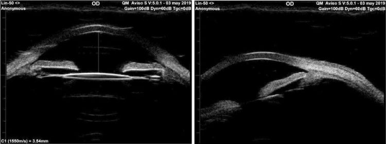 “Cirugía glauco-preventiva” ¿qué es, qué significa? – Oftalmólogo al Día
