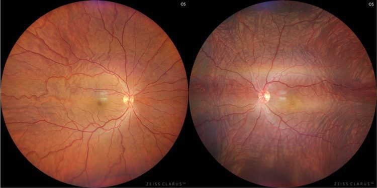 Efusión uveal, un reto diagnóstico – Oftalmólogo al Día