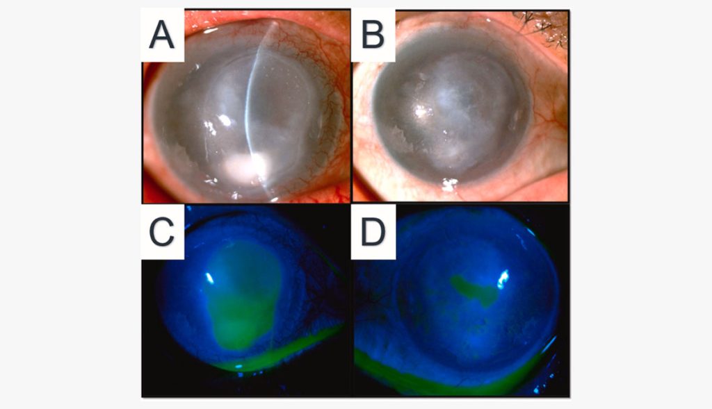Queratopatía Neurotrófica: Una visión general y una visión al futuro ...