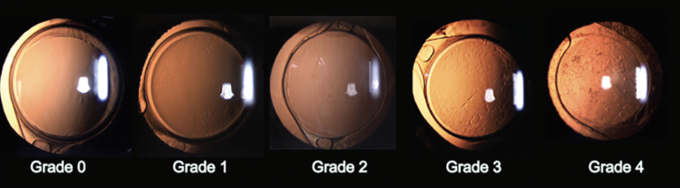 ¿Cuándo es seguro realizar una capsulotomía YAG para la opacificación ...
