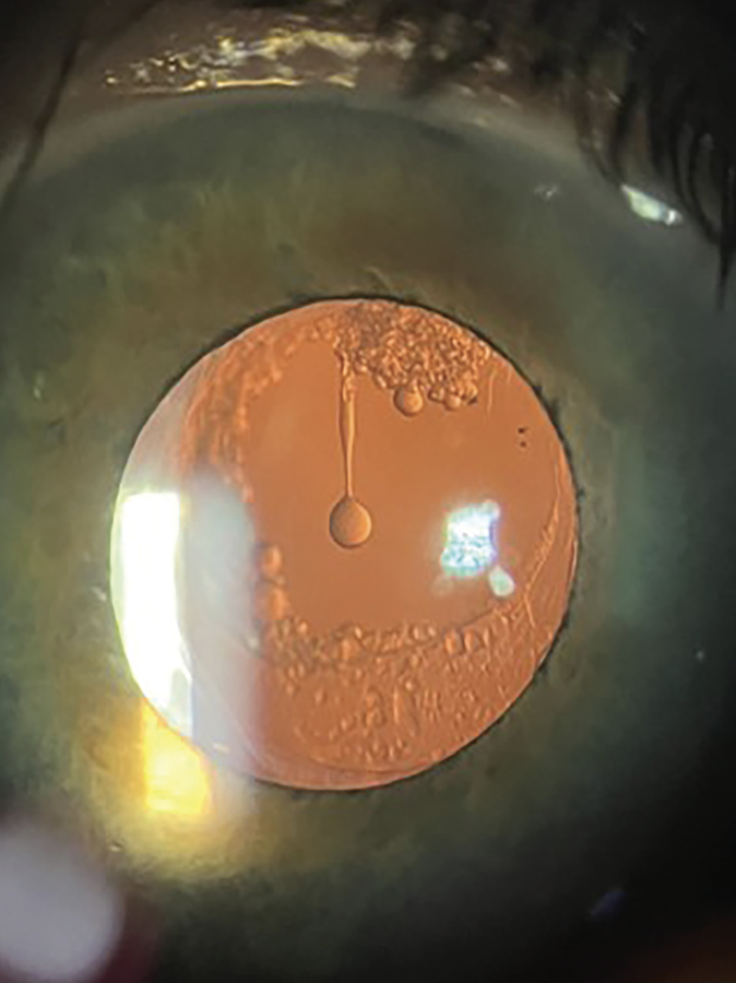 ¿Cuándo es seguro realizar una capsulotomía YAG para la opacificación ...