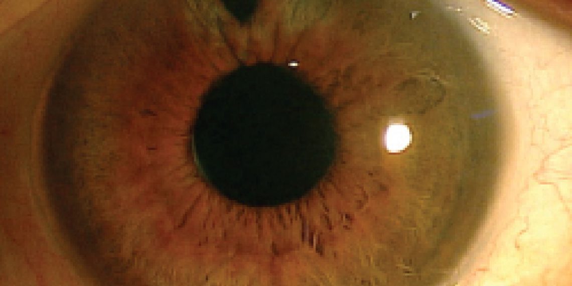 Campimetro computarizado | Octopus 900 | Perimetría de goldmann ...