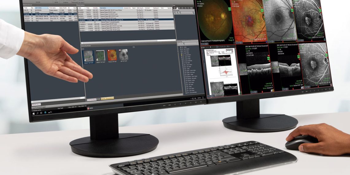 ¿Cuándo es seguro realizar una capsulotomía YAG para la opacificación ...