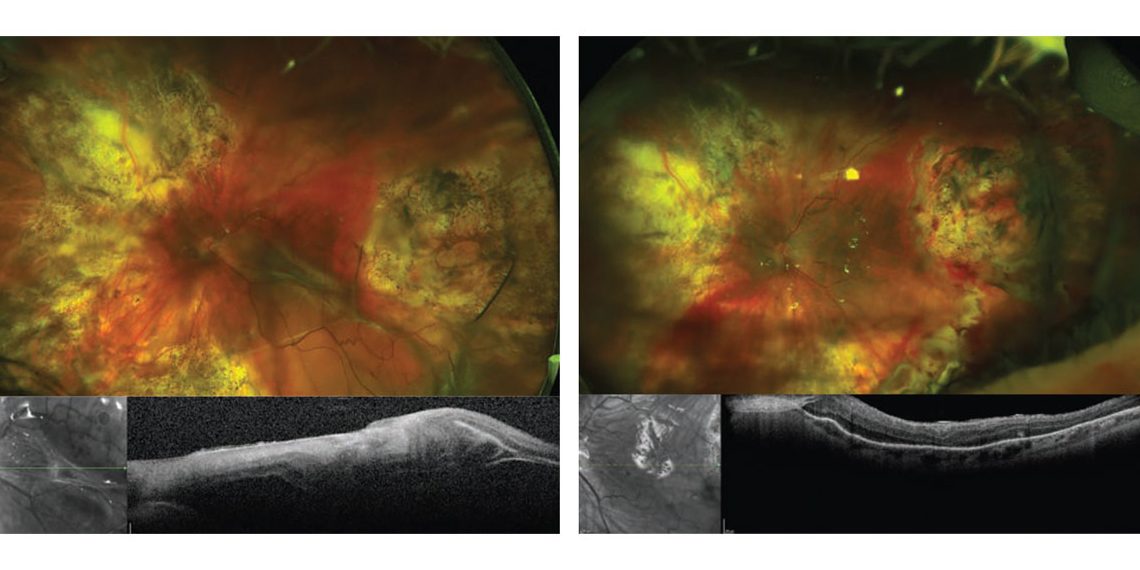 ¿Cuándo es seguro realizar una capsulotomía YAG para la opacificación ...