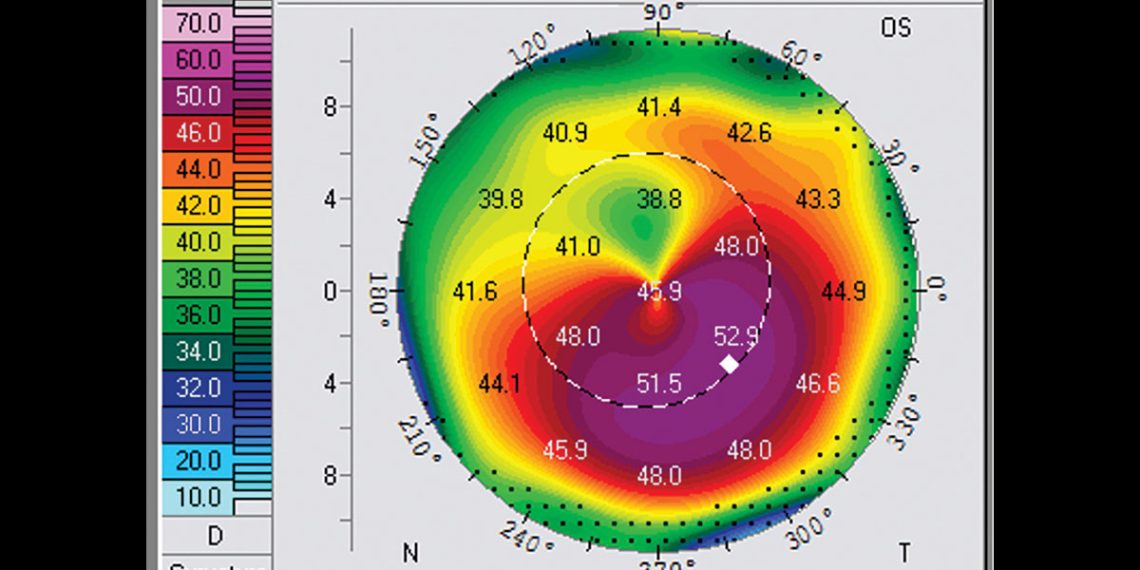 ¿Cuándo es seguro realizar una capsulotomía YAG para la opacificación ...
